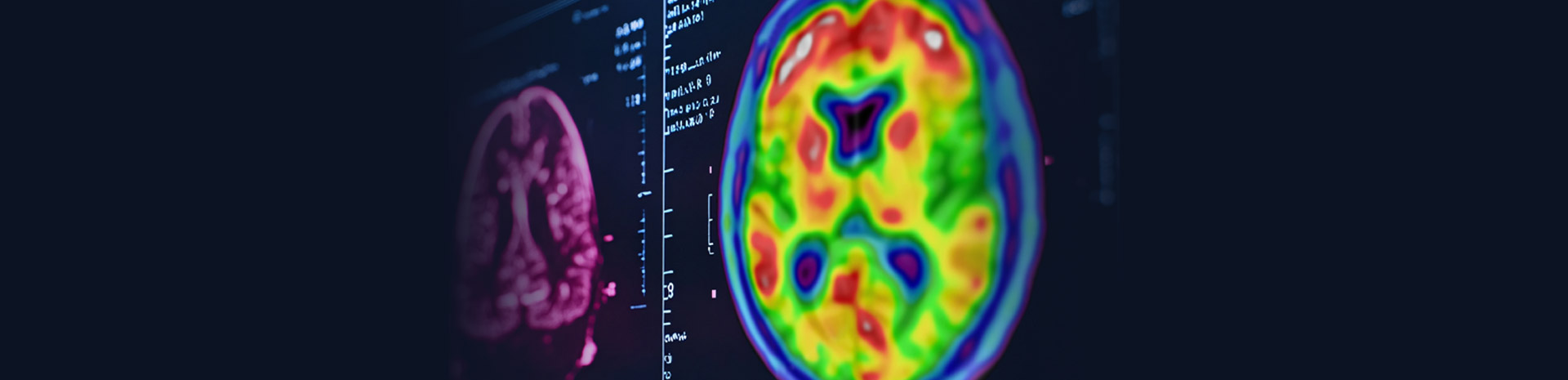 Amyloid PET Scan - Deaconess Illinois Union County